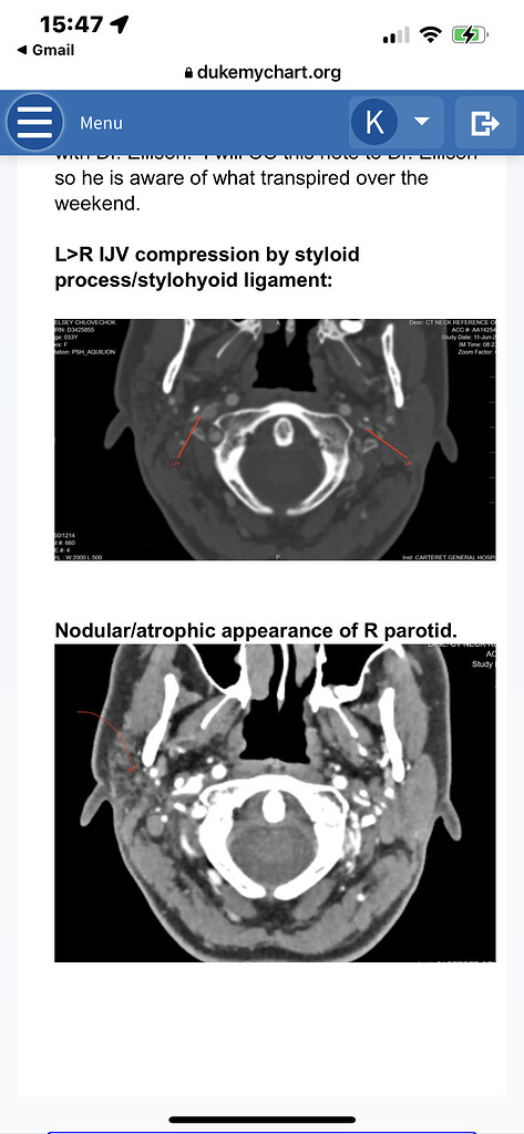 CTAs showing bilateral ES with left and right IJV compression ...