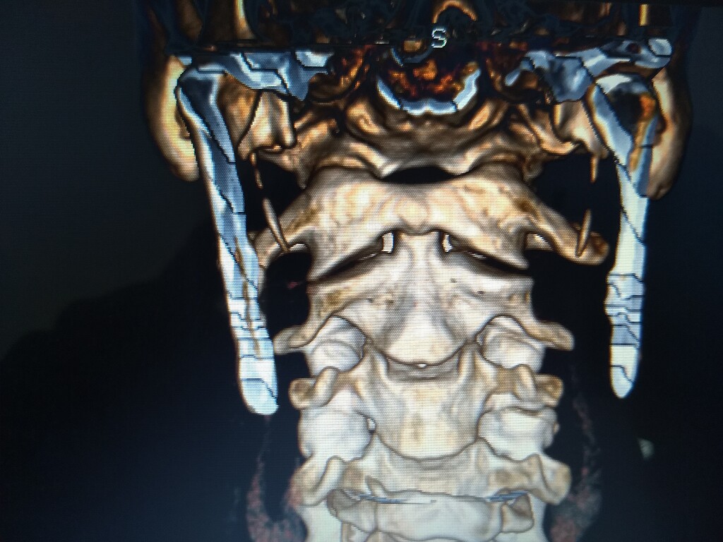 Calcified styloid ligaments 3D conversion no diagnosis - General ...