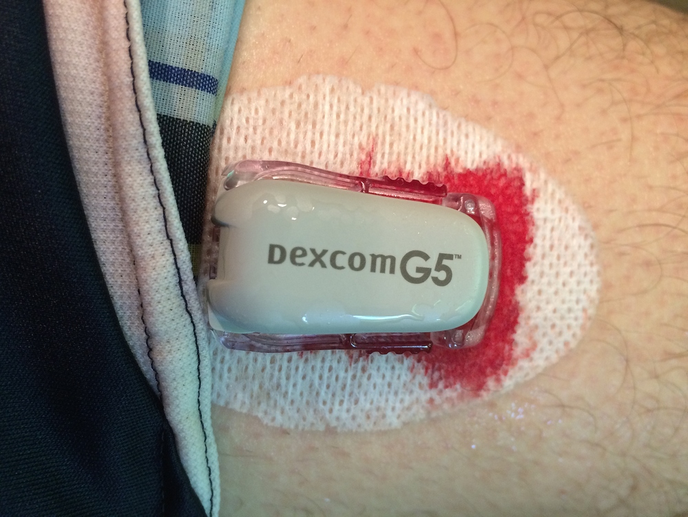 Dexcom fail! - C/GM - FUDiabetes